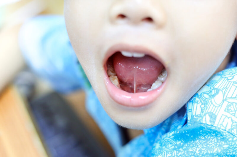 What is a tongue tie and why do we look for this during a dental ...