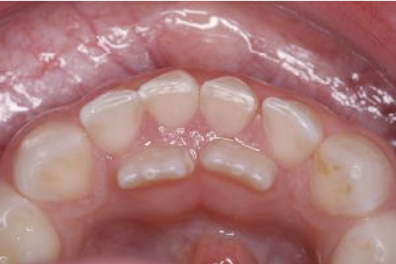 What are SHARK TEETH and should I be worried? - Kiddies Dental Care