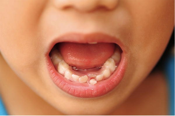 What are SHARK TEETH and should I be worried? - Kiddies Dental Care
