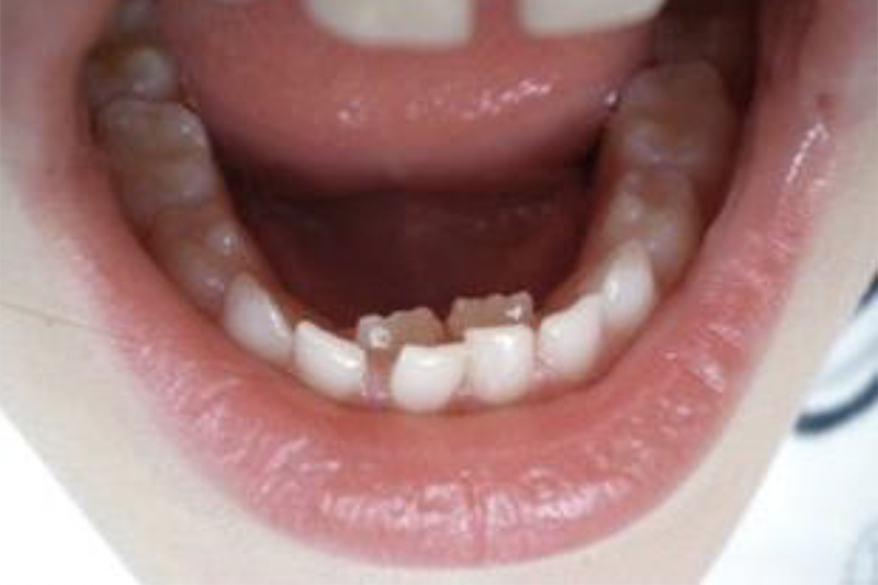 What are SHARK TEETH and should I be worried? - Kiddies Dental Care